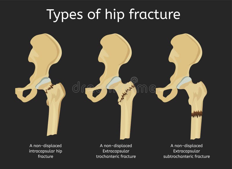 Pijn In De Heup Joint_femur Breuk Vector Illustratie - Illustratie ...