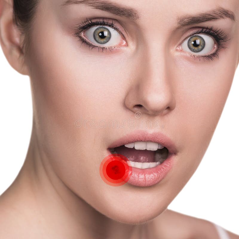 Sore on the female lips stock photo. Image of nasal, blister - 71298038