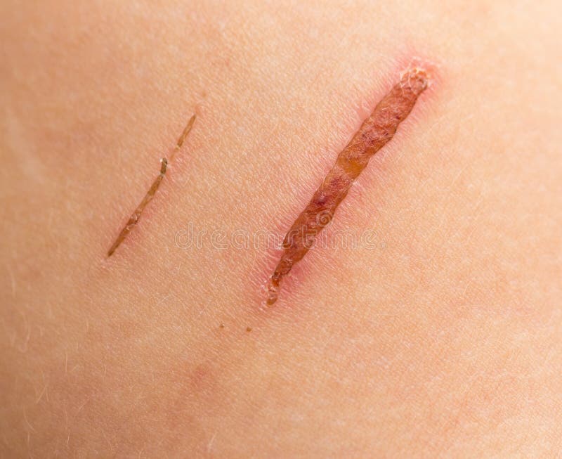 Sore on the skin stock photo. Image of scar, sore, blemish - 102492048