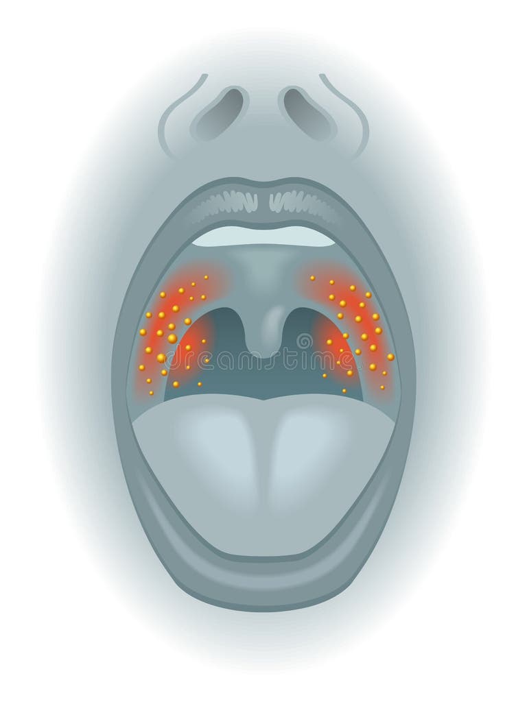 Bacterial Throat Infection Stock Illustrations – 511 Bacterial Throat ...