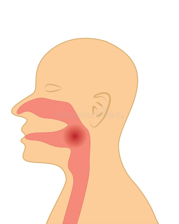 Sore Throat Stock Illustrations – 2,745 Sore Throat Stock Illustrations ...