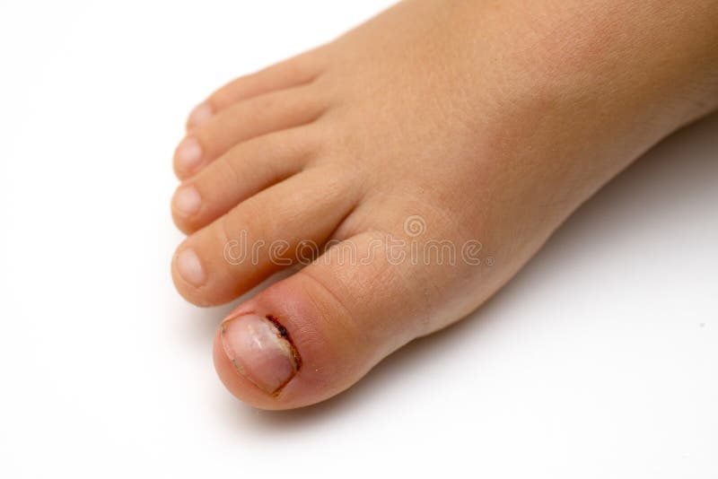 Paronychia, Swollen Finger Inflammation Due To Bacterial Infection on a ...