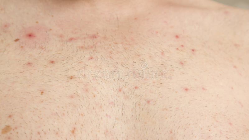 Sores and Rashes Where Monkeypox Occurs To the Skin 3 Stock Image ...