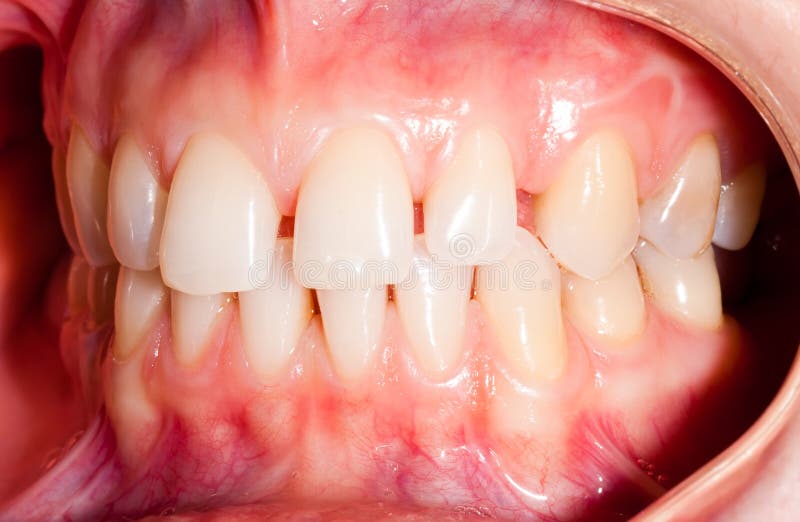 Space between teeth stock image. Image of oral, clinical - 41061853