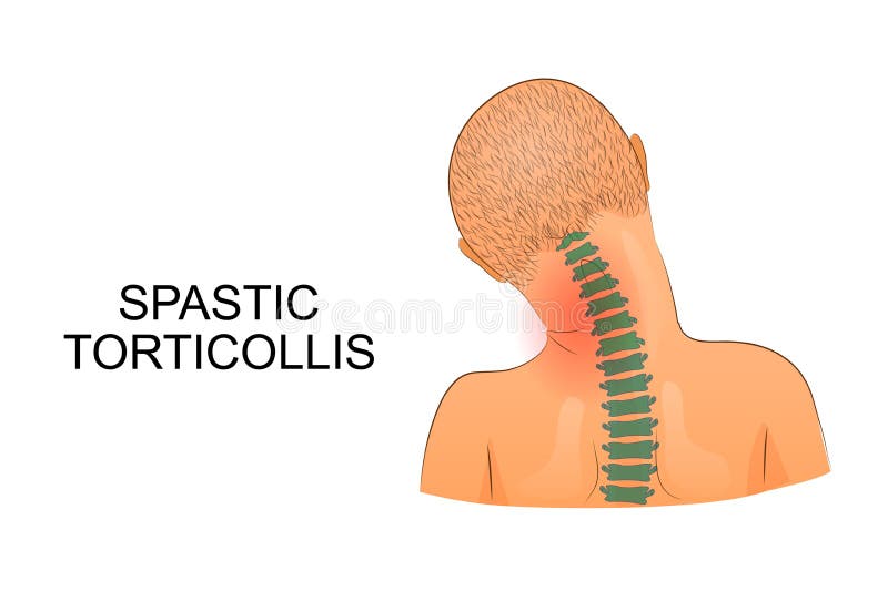 Spastic Torticollis in a Child Stock Vector - Illustration of clinical ...
