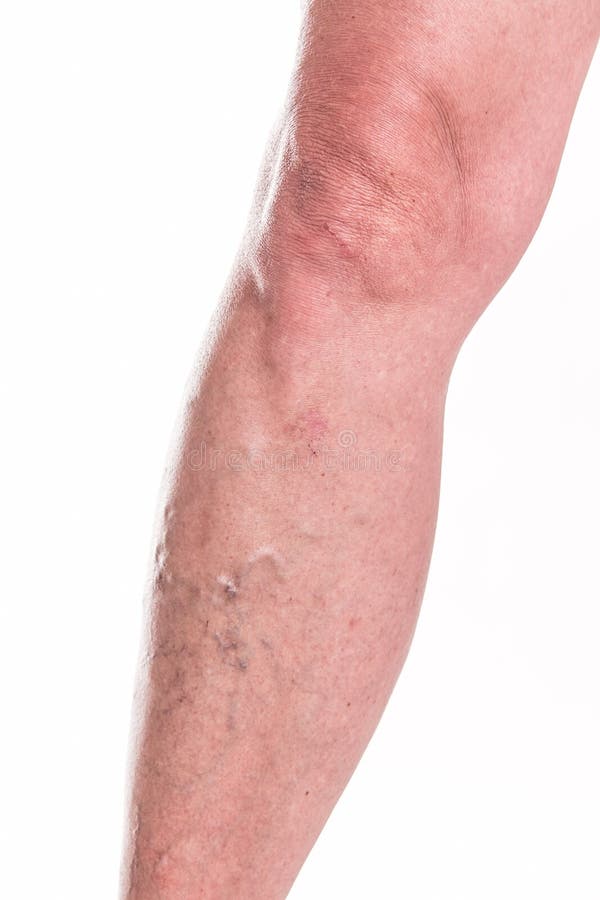 Spataders Op De Benen Van Vrouw Stock Foto - Image of beweging, druk ...