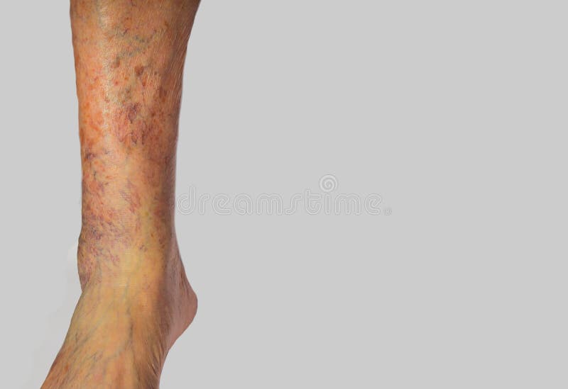 Spataders Op Een Mannelijk Been Stock Foto - Image of voet, oudste ...