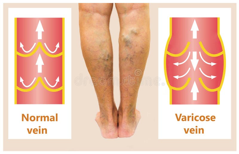 Spataders Op Een Vrouwelijk Hoger Been Stock Afbeelding - Image of zorg ...