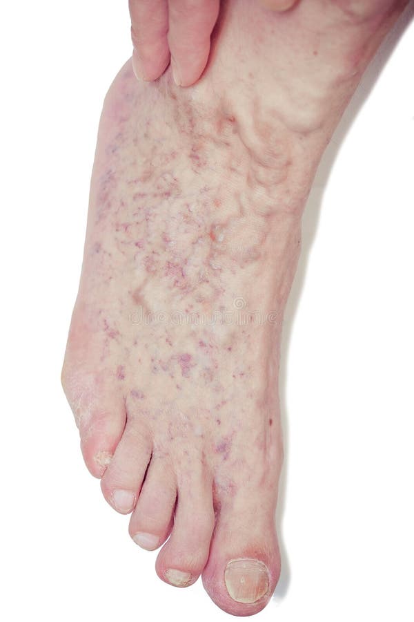 Spataders op het been stock afbeelding. Image of achtergrond - 54259601