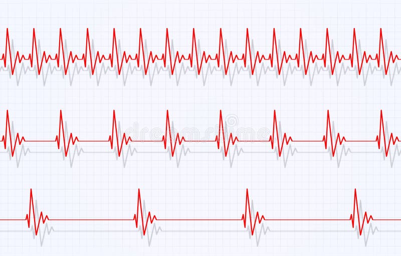 Fast Normal Slow Heartbeat Illustration Stock Illustration ...