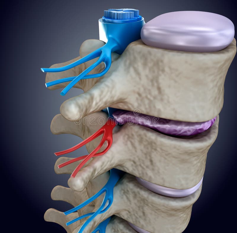 Spinal Cord Under Pressure of Bulging Disc Stock Illustration ...