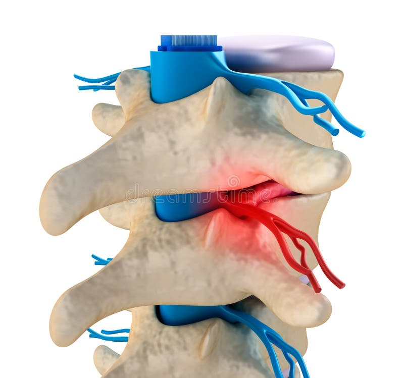 Spinal Cord Under Pressure of Bulging Disc Stock Illustration ...