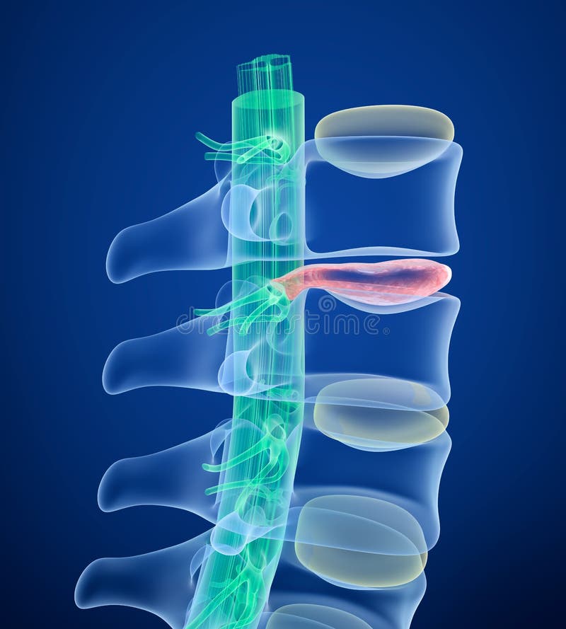 Spinal Cord Under Pressure of Bulging Disc, X-Ray View. Stock ...