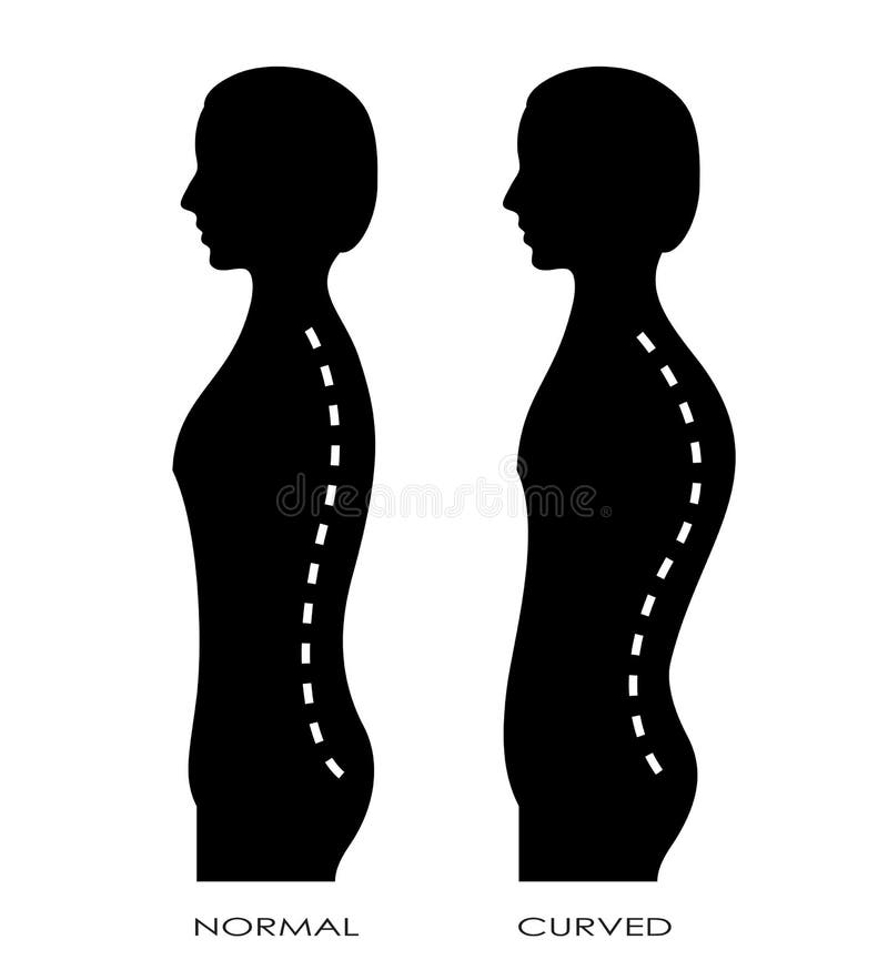 Spinal curvature stock vector. Illustration of posture - 53215486
