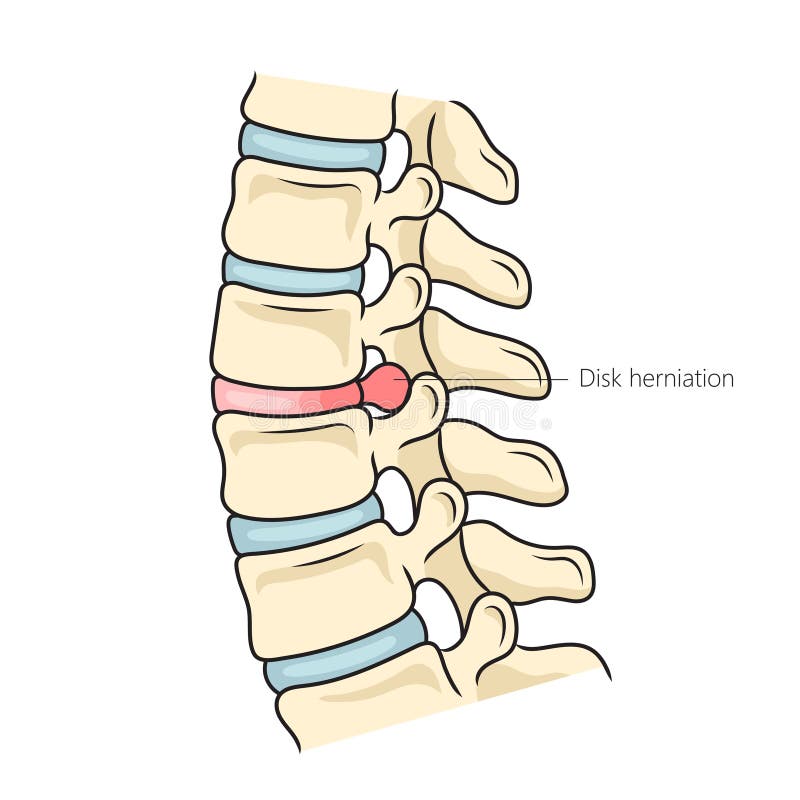 Disc Herniation Stock Illustrations – 199 Disc Herniation Stock ...