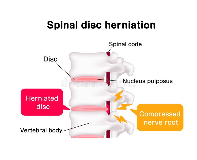 Spinal Disc Herniation Illustration Stock Vector - Illustration of ...