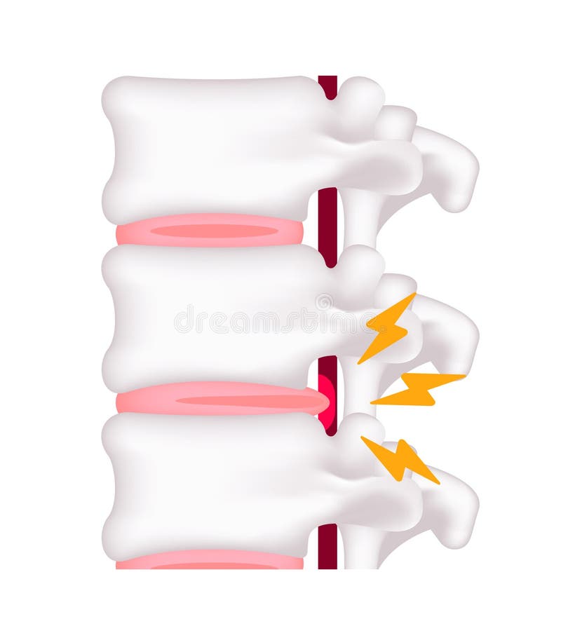 Spinal Disc Herniation Illustration Stock Vector - Illustration of ...