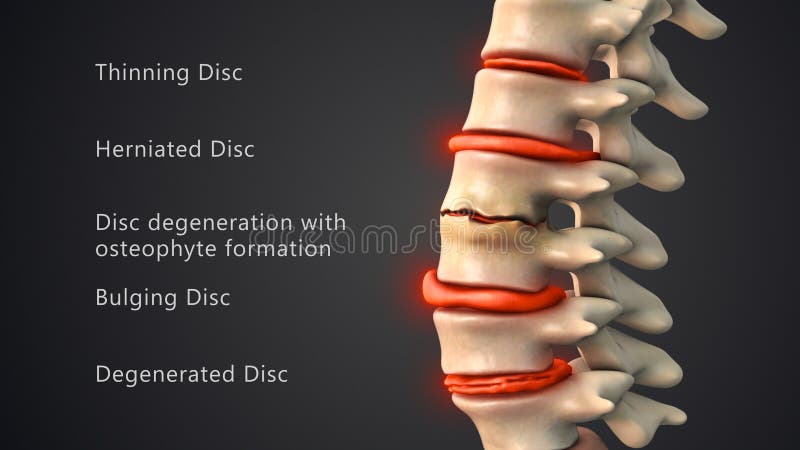 Tear Vertebrae Stock Photos - Free & Royalty-Free Stock Photos from ...