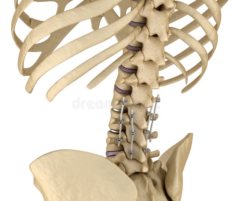 Spinal Fixation System - Titanium Bracket Stock Illustration ...