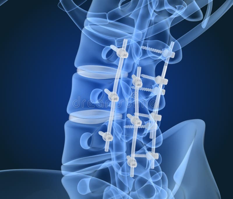 Spinal Fixation System - Titanium Bracket Stock Illustration ...