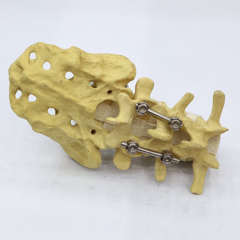Spinal Fixation System - Titanium Bracket Stock Photo - Image of ...