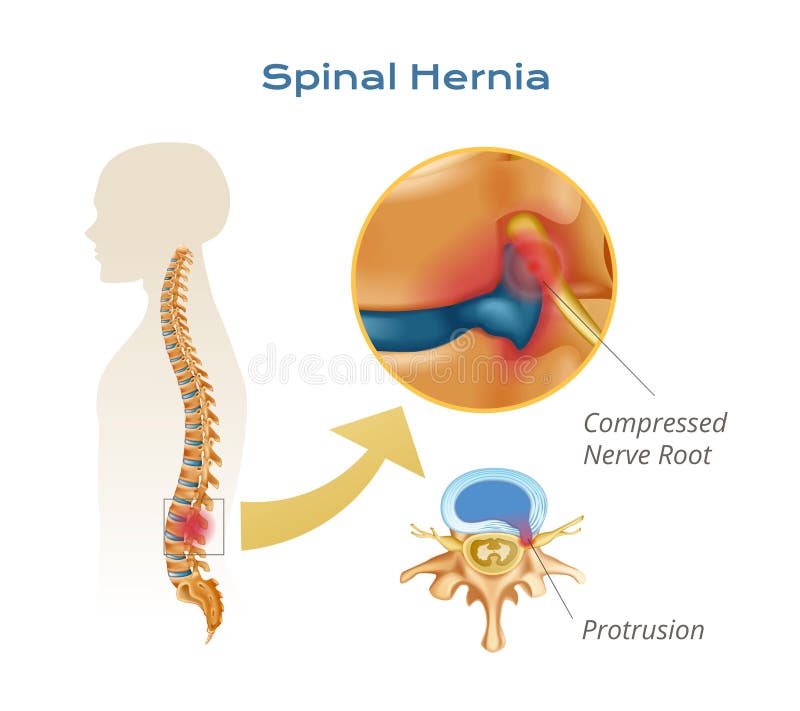 Spinal Hernia Anatomy Infographics Stock Vector - Illustration of nerve ... Spinal Hernia Anatomy Infographics Stock Vector - Illustration of nerve ...