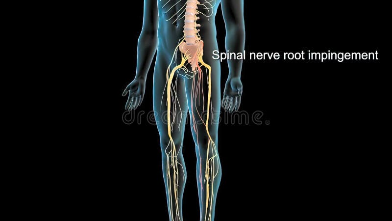 Spinal Nerve Root Impingement - 3D Illustration Stock Illustration ...