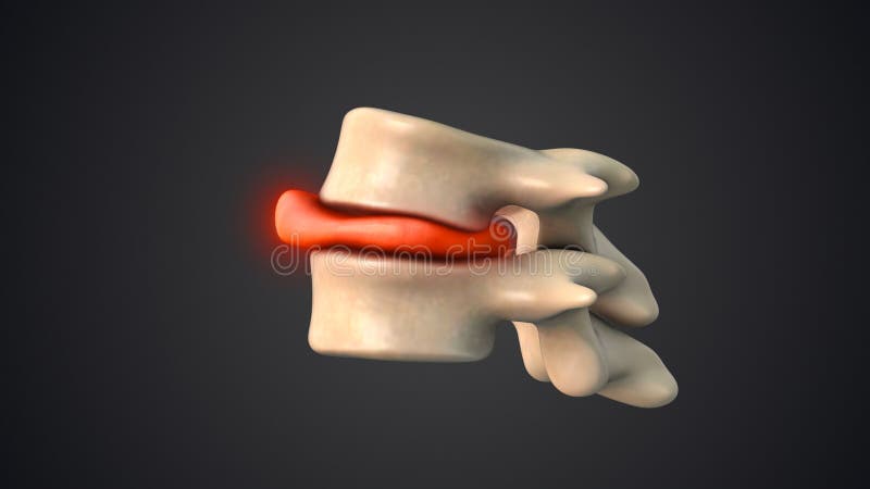 Bulging Disc Stock Illustrations – 196 Bulging Disc Stock Illustrations ...