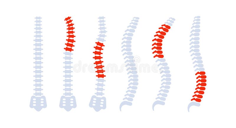 Spine Bones with Back Pain Highlighted Showing Different Problems Stock ...