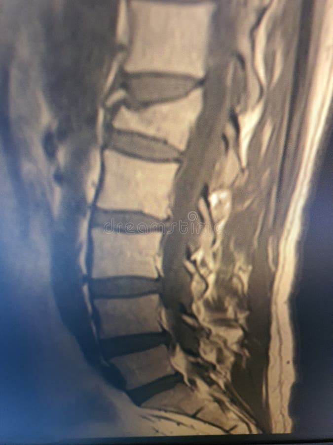Spine with Broken Vertebrae. Xray Back Risonanza Stock Image - Image of ...