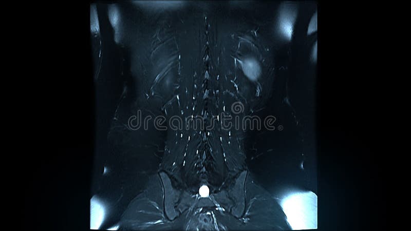 Spine MRI Scan stock video. Video of anatomy, radiology - 71779201