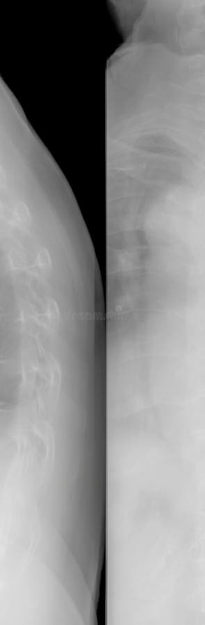 Spine and Pelvis of a Human Body on X-ray. Two Different Split Views ...