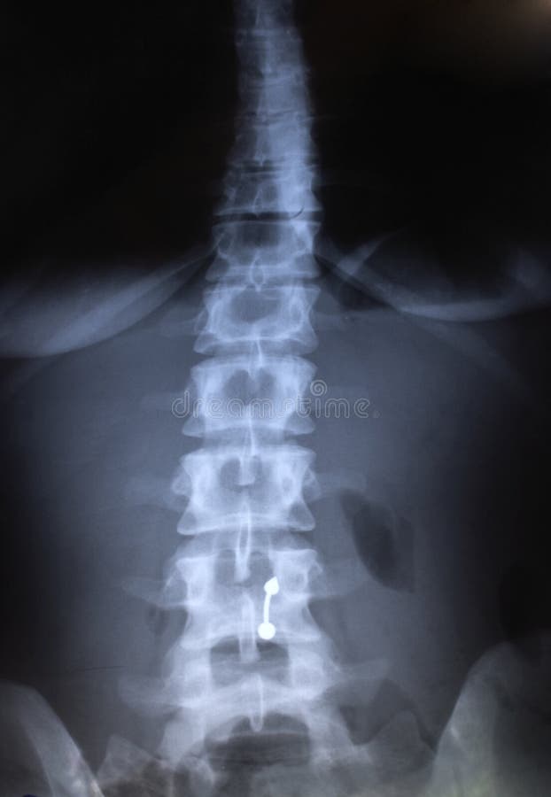 Spine Radiography - X Rays stock image. Image of diagnostic - 1234679