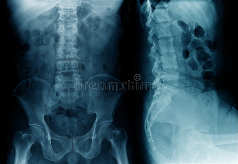 Lumbar Spine X-ray, Lower Back Stock Photo - Image of herniation, lower ...