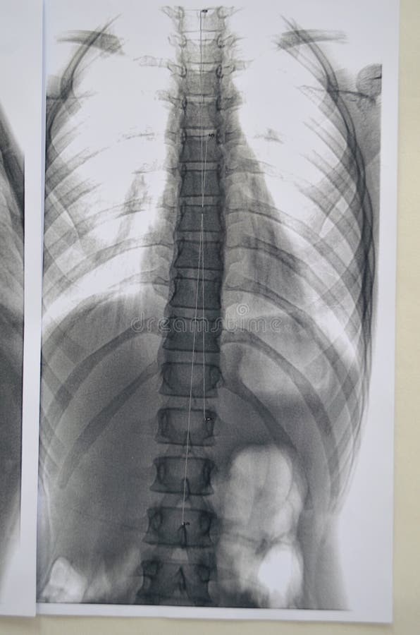 Spine Rengen picture stock photo. Image of hematoma, inspection - 85340988
