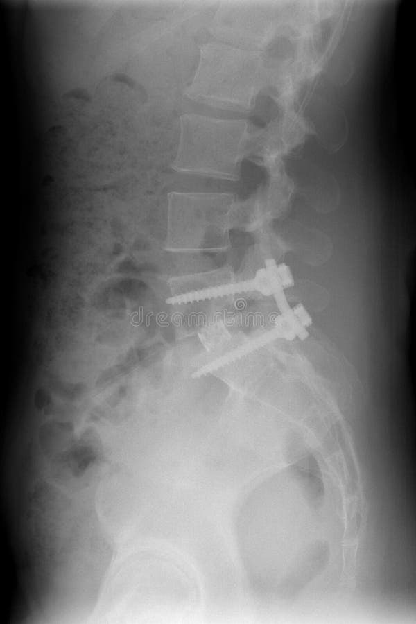 Spine Surgical Reconstruction Stock Image - Image of lateral ...