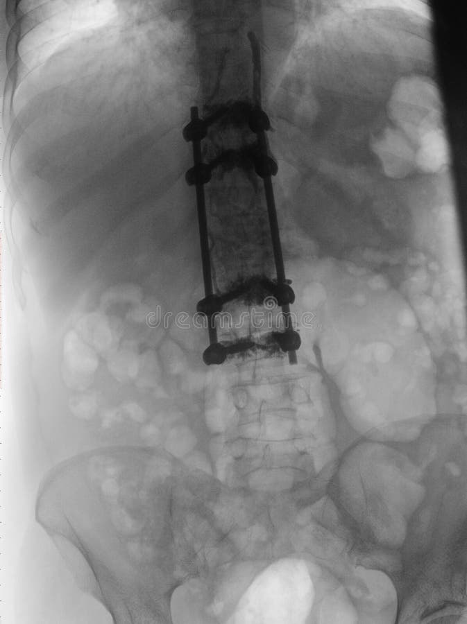 Spine Surgical Reconstruction Stock Photo - Image of roentgenogram ...