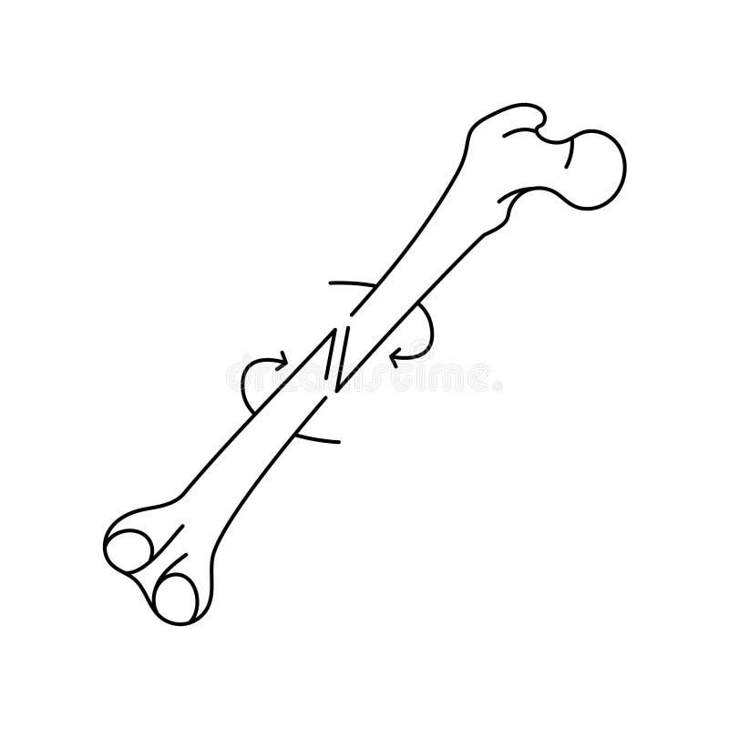 Spiral Bone Fracture Line Icon. Stock Vector - Illustration of ...