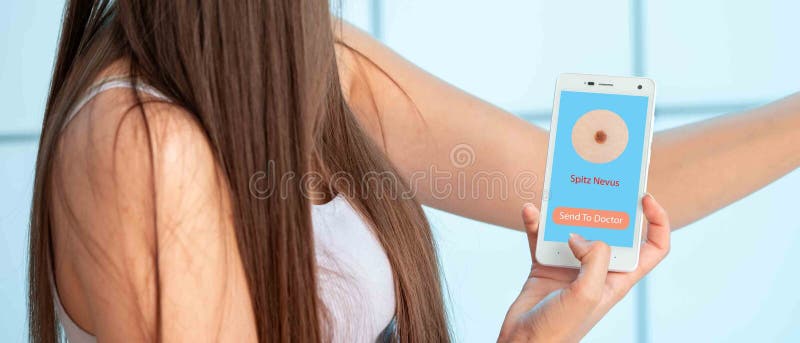 Spitz Nevus. Check for a Neoplasm or Mole on the Skin Using an Applica ...