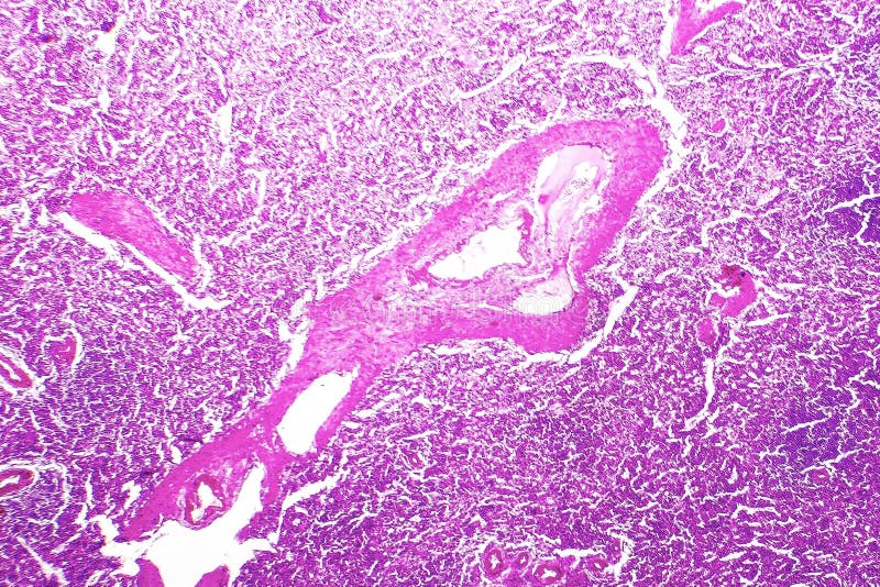 Splenic Arterioles Hyalinization Stock Image - Image of medicine ...