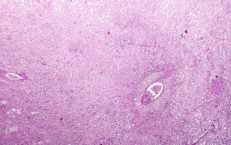 Hemorrhagic Infarct of the Lung Stock Photo - Image of medicine ...