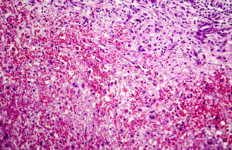 Splenic Infarction, Photo Under Microscope Stock Image - Image of ...