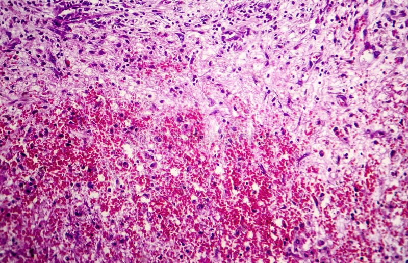 Splenic Infarction, Photo Under Microscope Stock Photo - Image of ...