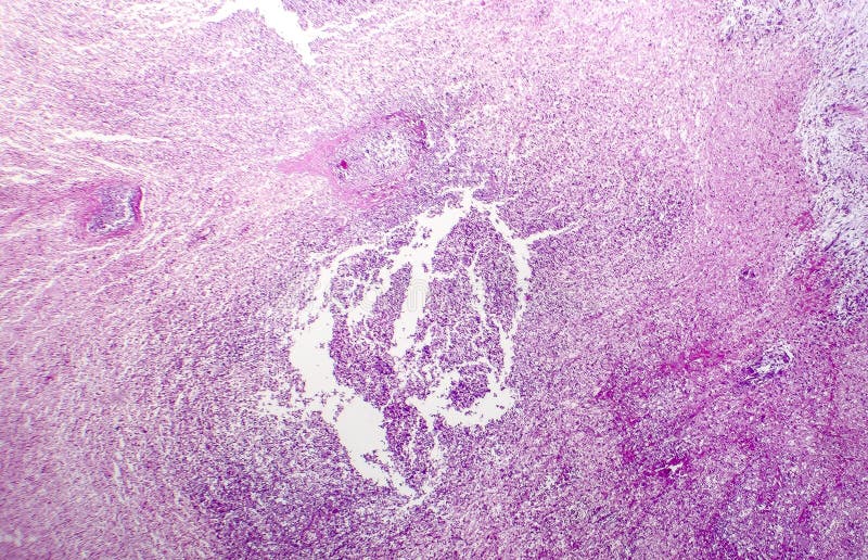 Hemorrhagic Infarct of the Lung Stock Photo - Image of medicine ...