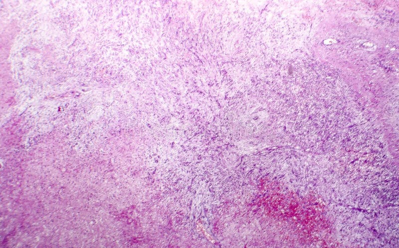 Splenic Infarction, Photo Under Microscope Stock Photo - Image of ...