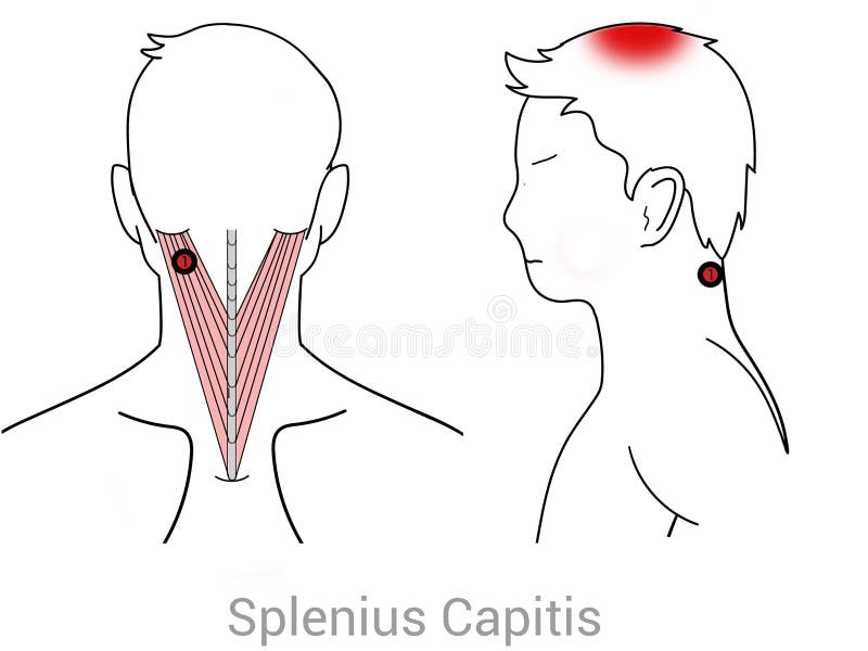 Splenius Capitis: Treating Crown Headaches Caused by Splenius Capitis ...