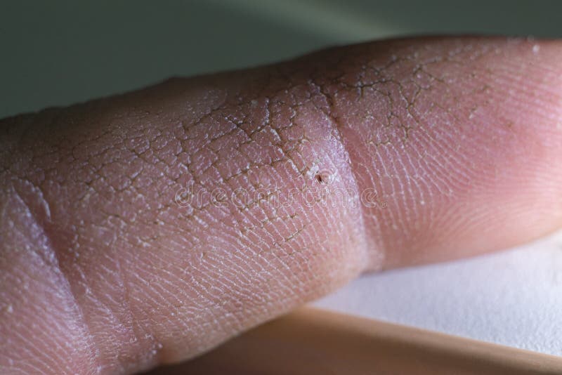 A Splinter in a Person& X27;s Finger Stock Image - Image of infection ...