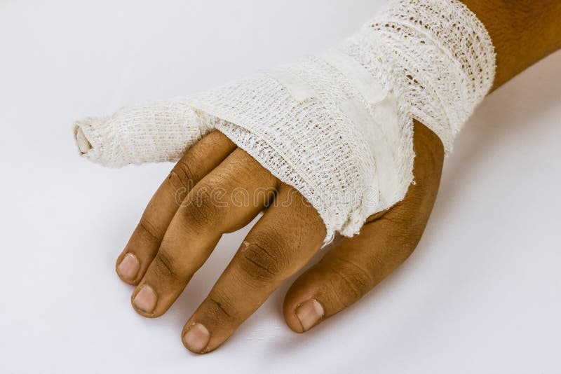 Gebroken Vinger In Een Splinter Stock Afbeelding - Afbeelding bestaande ...