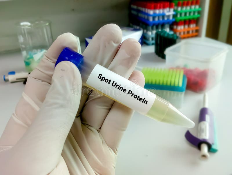 Urine Sample for Urine PCR (Protein Creatinine Ratio) Test. Closeup ...