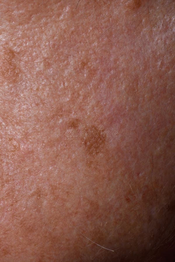 423 Liver Spots Stock Photos - Free & Royalty-Free Stock Photos from ...